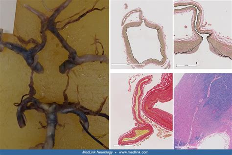 Lacunar Stroke Pathophysiology Pdf Advances In Understanding The