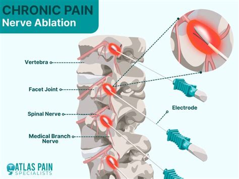 Nerve Ablation Costs What You Need To Know Before Treatment