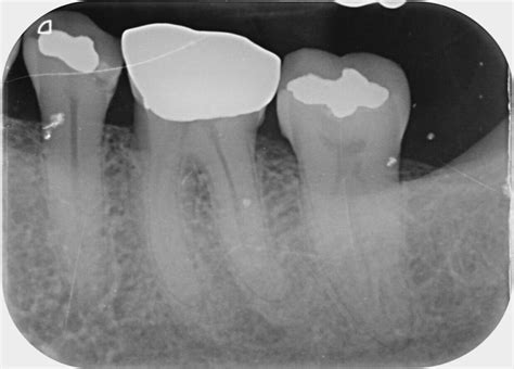 Laser Assisted Irrigation In Endodontic Treatment