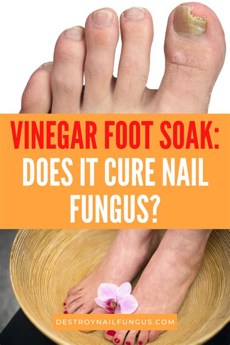 Nail Fungus Remedy Guide How Does Vinegar Kill Fungus