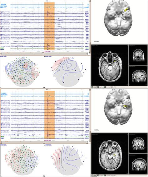 Multimodal Neuroimaging And Treatment In Medically Refractory Epilepsy Caused By Occult Temporal