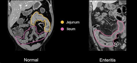 Abdominal Ct Enteritis And Colitis • Litfl • Radiology Library