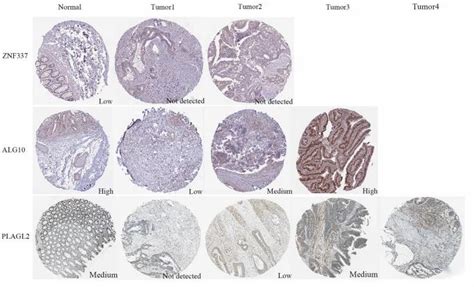 放疗抵抗方向，生物标志物筛选gwas等多组学分析预后分析8分纯生信，性价比简直太高了！ 知乎