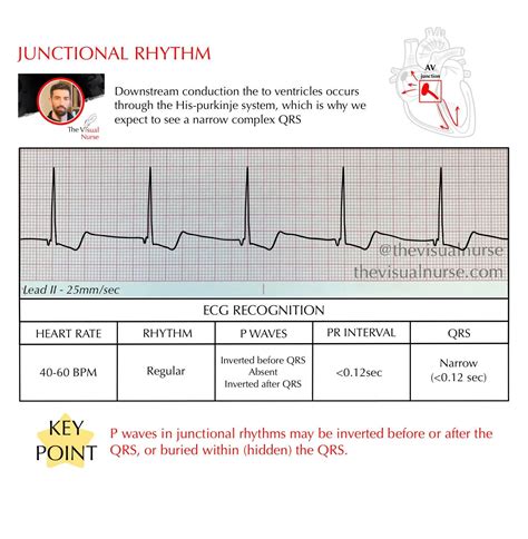 Junctional Tachycardia Treatment Narrow Complex Tachycardias