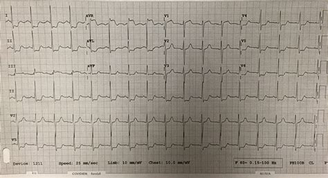 Interesting Left Main Occlusion Dr Smiths Ecg Blog