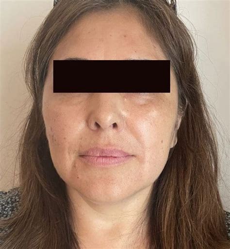 Dermal Fillers Before And After Case 6 Female Age 45 54 Clinique