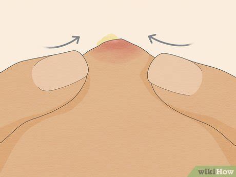 Simple Ways To Pop A Pimple Or Zit WikiHow