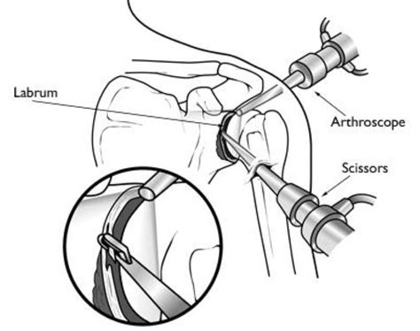 Posterior Labral Tears And Slap Tears Adam Watson Orthopaedic Surgeon