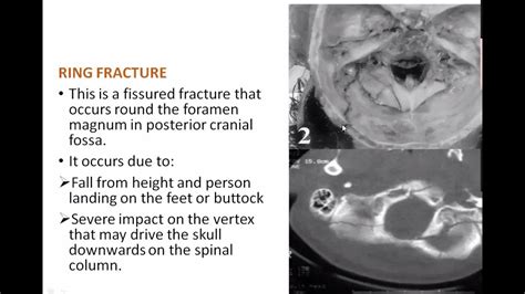 What Is A Hinge Skull Fracture At Linda Weiner Blog