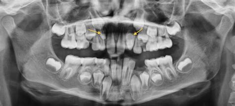 Dens Invaginatus Pacs