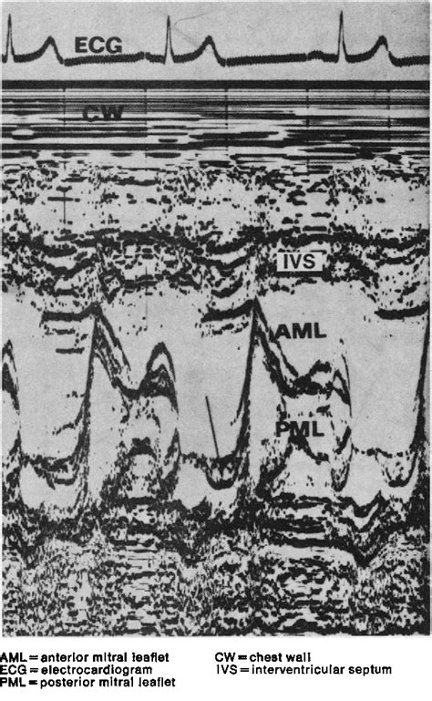 Mitral Valve Prolapse Complicated By Ruptured Chordae Tendineae Semantic Scholar