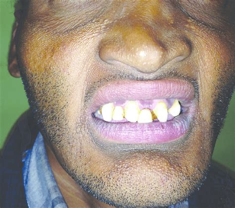 What Are Conical Teeth At Joshua Calyute Blog