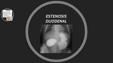 Estenosis Duodenal By Aurora Hernandez On Prezi