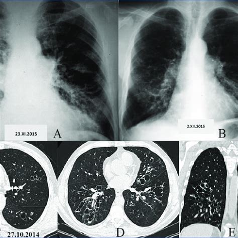 Basic Morphologic Types Of Bronchiectasis Recognized On Ct Axial Ct Download Scientific
