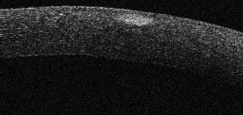 Corneal OCT Reveals A Hyper Reflective Area Immediately Behind The Download Scientific Diagram