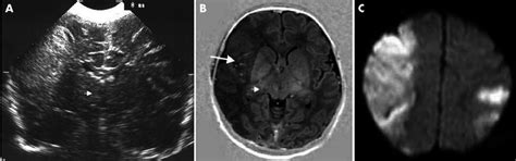 A Typical Triangular Area Of Echogenicity In The Right Hemisphere