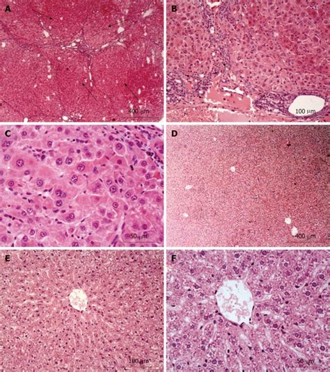 Increased Expression Of Chondroitin Sulphate Proteoglycans In Rat Hepatocellular Carcinoma