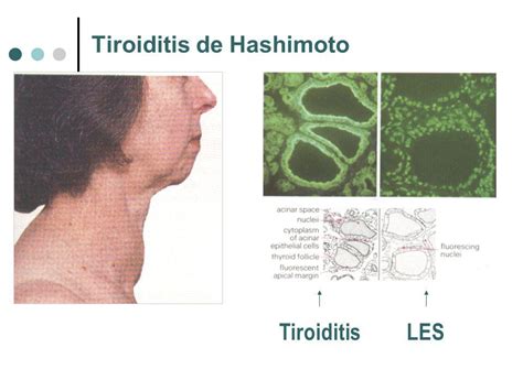 InmunopatologÍa De La Hipersensibilidad Tipo Ii Ppt Video Online