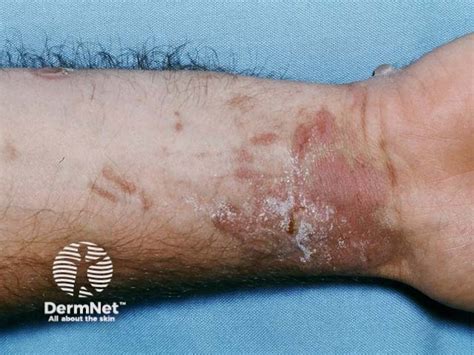 Skin Problems In Beauticians