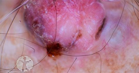 Nodular Melanoma Image