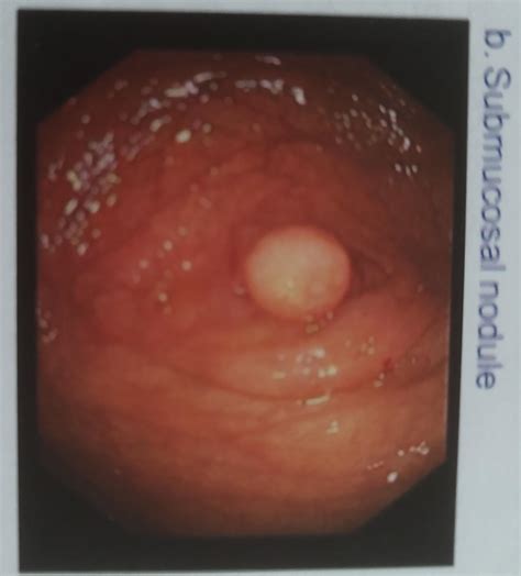 Submucosal Nodule In Small Intestine R Medical