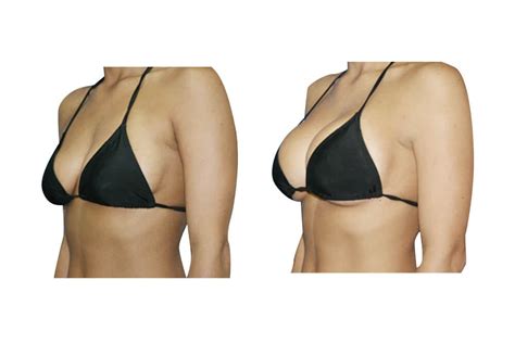 How To Use A Breast Enlargement Pump A Comprehensive Useful Guide Minxu