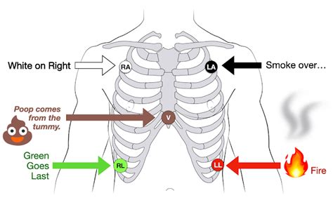 Heart Monitor Lead Placement Antlader