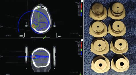 Cone Based Stereotactic Radiosurgery Treatment And Different Cones
