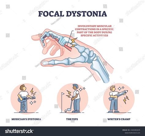 Muscle Spasm Dystonia At Marsha Shain Blog