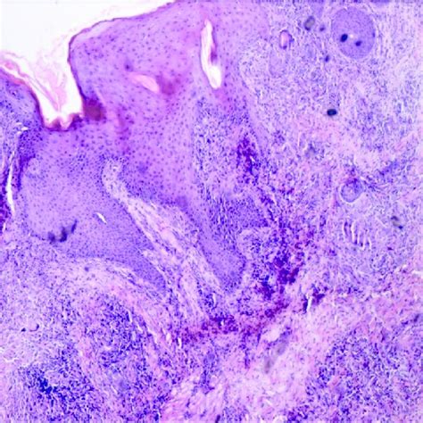 Skin Biopsy Showing Hyperplastic Epidermis Upper And Mid Dermis