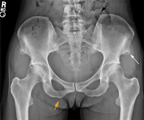 What Is Spinal Enthesopathy Lumbar Region At Maggie Jose Blog