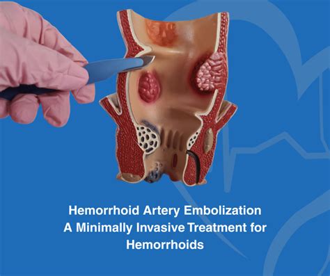Hemorrhoid Artery Embolization A Minimally Invasive Treatment For