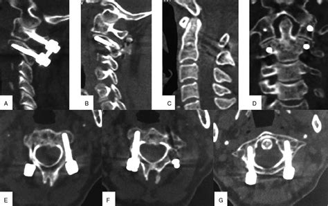 Postoperative Radiology Sagittal Computed Tomography Reconstruction