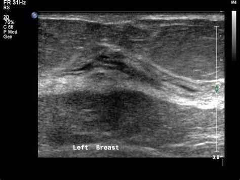 Atlas Of Breast Cancer Early Detection