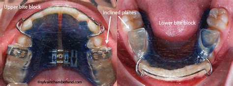 Twin Block Orthodontist In Quebec City