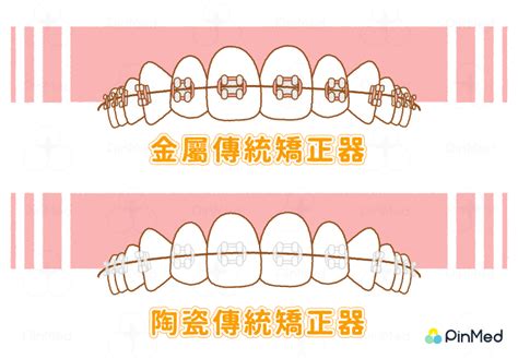 牙齒矯正費用多少合理？一次了解優缺點、療程時長 Pinmed