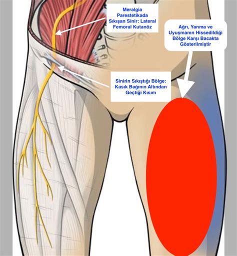 Meralgia Paresthetica Causes Symptoms And Treatment Options