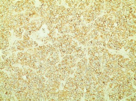 Immunohistochemistry Shows A Inhibin Staining As Strongly Positive D