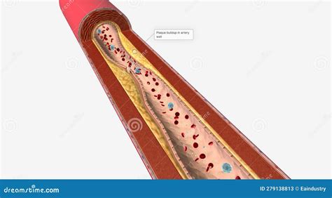 Hypertriglyceridemia Is A Common Condition Characterized By High Stock Illustration