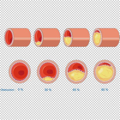 Atheroma Obstruction Vector Scientific Illustration