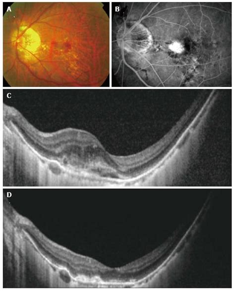 Choroidal Neovascularization Oct