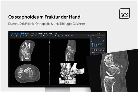 Perspektive Scs „fallvorstellung Os Scaphoideum Fraktur Der Hand“ Scs
