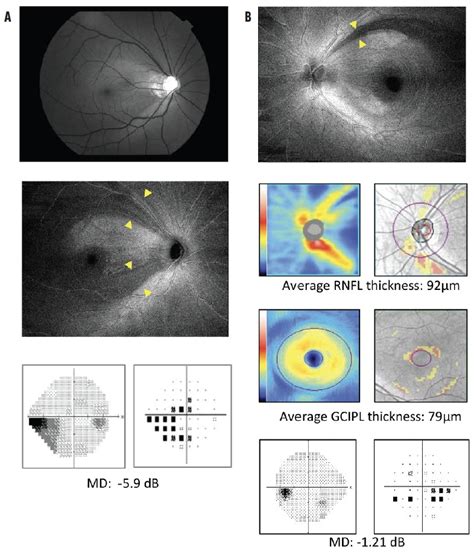 Retinal Nerve Fiber Layer Optical Texture Analysis Glaucoma Today