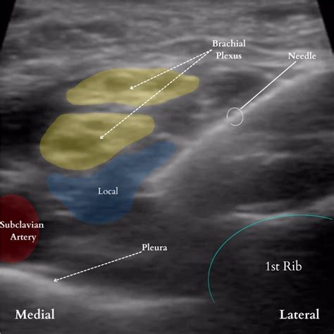 Supraclavicular Brachial Plexus Block BABY BLOCKS
