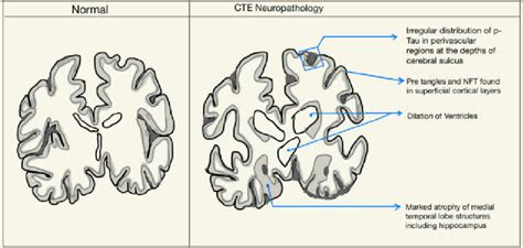 Neuropathological Features In The Diagnosis Of Cte Download