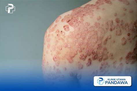 Jangan Panik Begini Cara Efektif Mengobati Psoriasis Eritroderma