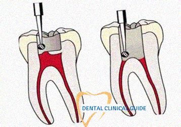 Pulpotomy In Primary Teeth A Clinical Guide Step By Step