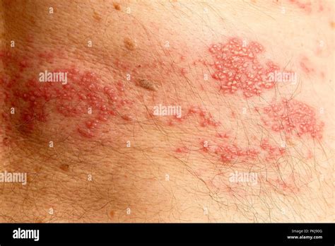 Shingles Rash Chest