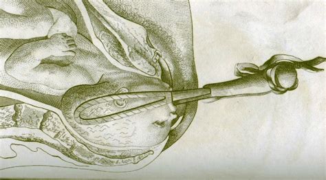 How One Family Kept The Invention Of Forceps A Secret For Two Centuries