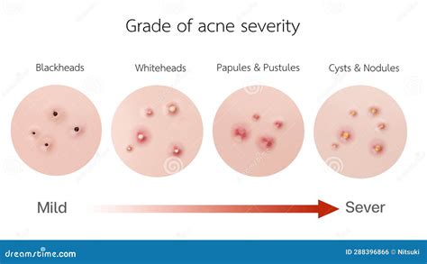 Acne Type Collection And Severity Concept Stock Illustration Illustration Of Pores Facial